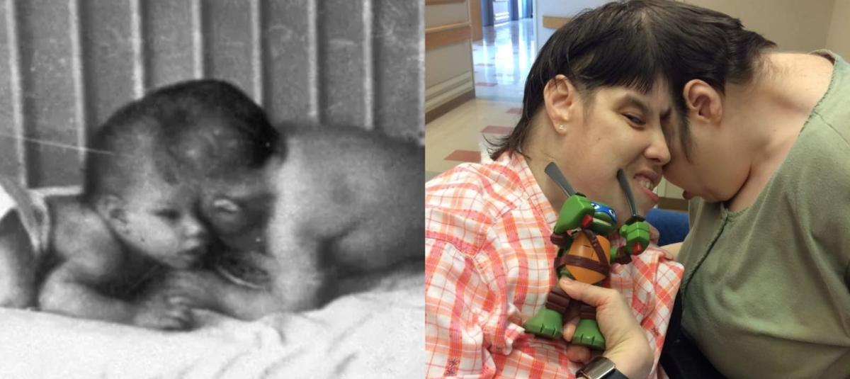 Mueren Lori y George Schappell, los gemelos siameses más longevos del ...