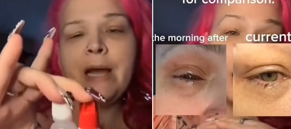 Mujer confundió las gotas para los ojos con pegamento para uñas y tuvo ...