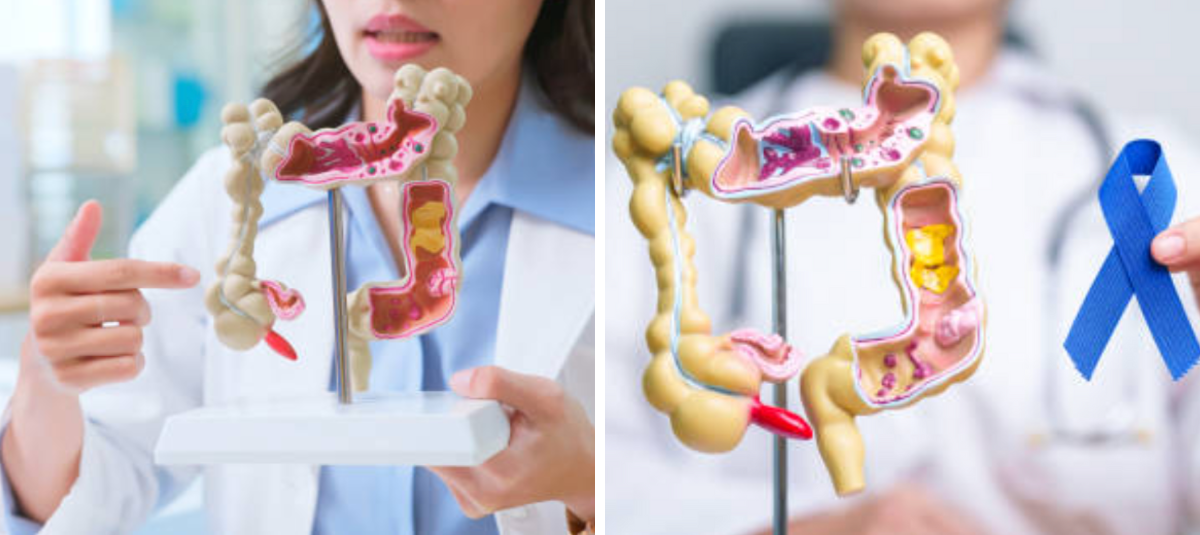 Ojo: estos son los cuatro síntomas claves del cáncer de colon que aparecen en las personas ...