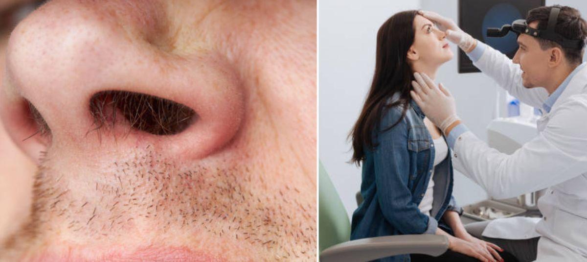 Los síntomas del cáncer de nariz que confunden a las personas con otras ...