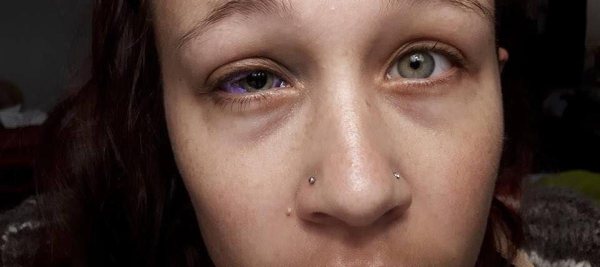 Modelo pierde parcialmente la visión por tatuaje ocular