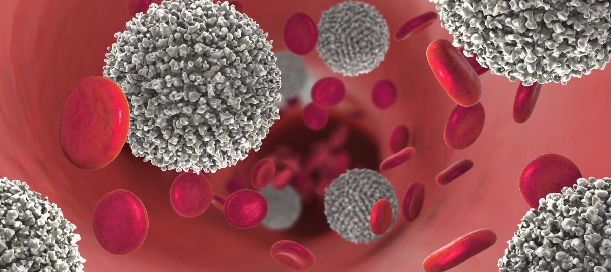 El tipo de leucemia más frecuente y que afecta a los adultos mayores ...