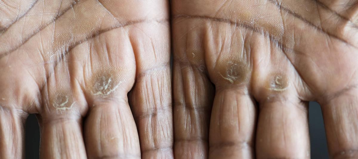 ¿Cómo eliminar los callos de las manos?