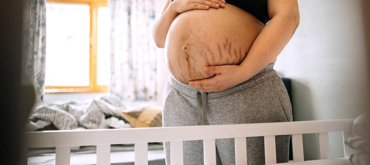 Estrías rojas: ¿Por qué salen y cómo se quitan?