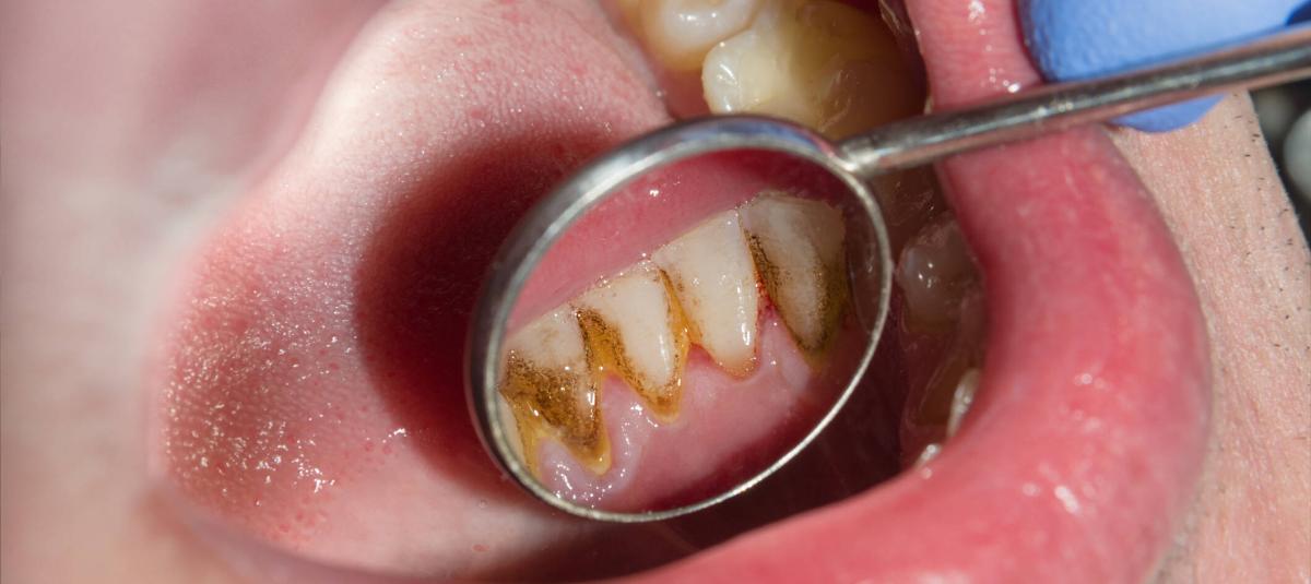 Sarro dental: ¿Cuáles son sus causas y como puede eliminarlo?
