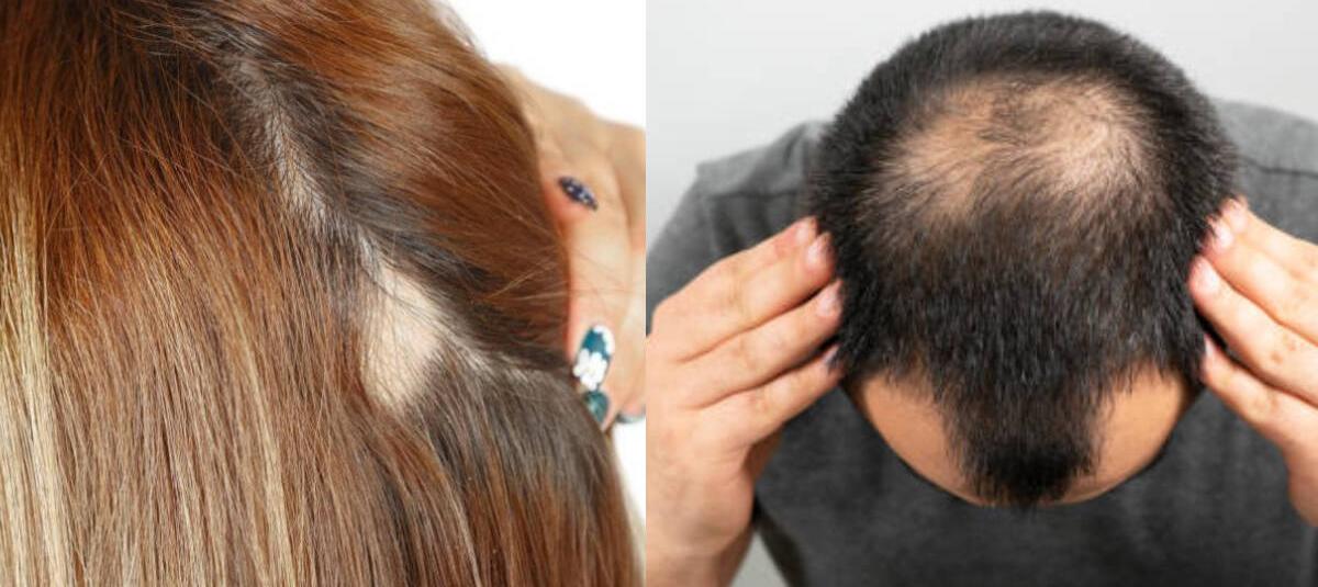 Calvicie o alopecia: ¿cómo impedirla y qué opciones médicas existen?