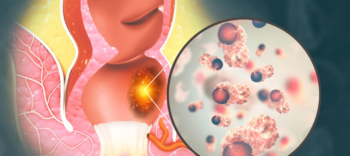 Cáncer de ano: ¿qué es y cuáles son sus síntomas?