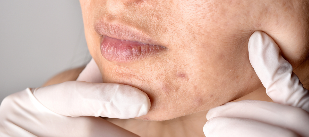 ¿Qué es el acné quístico?