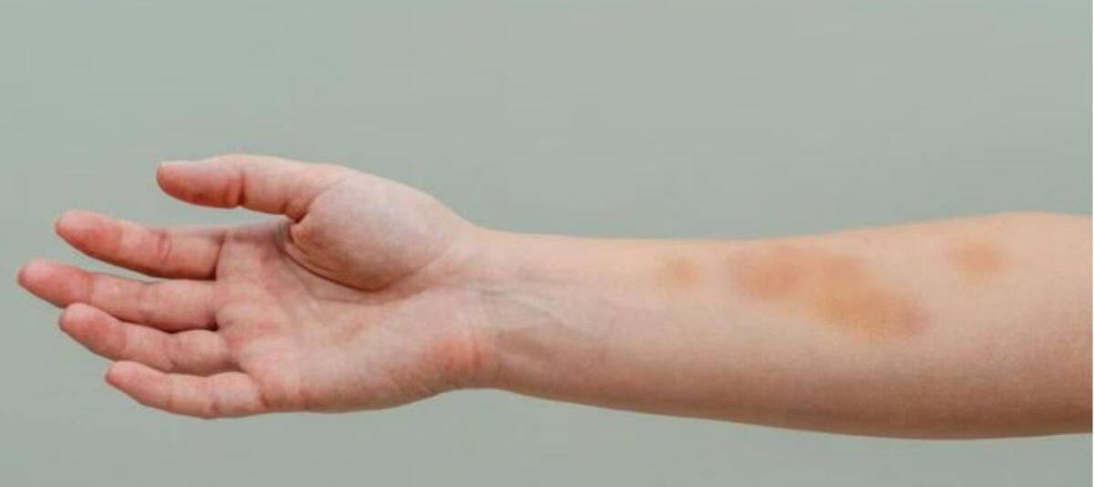 Las razones por las que los hematomas o ‘morados’ van cambiando de ...