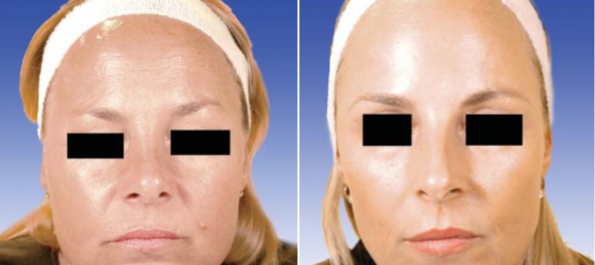 ¿Funciona el bótox? Estudio compara gemelas: una aplicó la toxina por ...