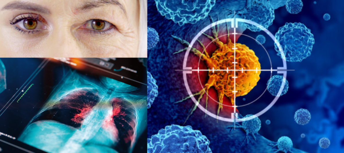 Este signo facial podría alertar la presencia de cáncer de pulmón ...