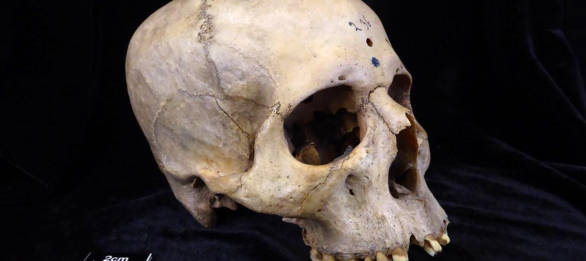 Revelan antiguo cráneo con cáncer cerebral: los restos encontrados ...