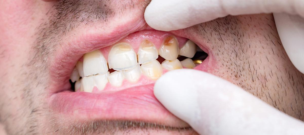 El elixir blanqueador: la bebida que elimina el sarro y se prepara con ...