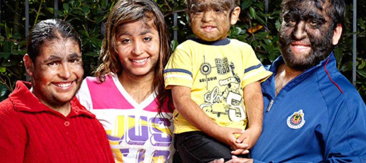 Así está en 2024 'el hombre lobo', quien ganó un Récord Guinness