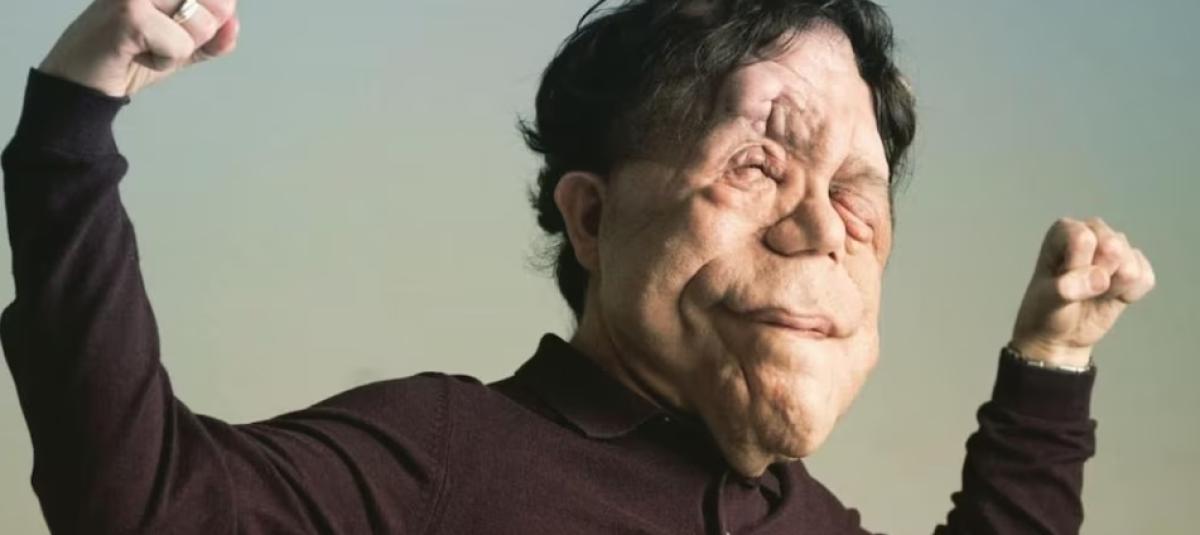Esta es la enfermedad que sufre el actor Adam Pearson, la cual le ...