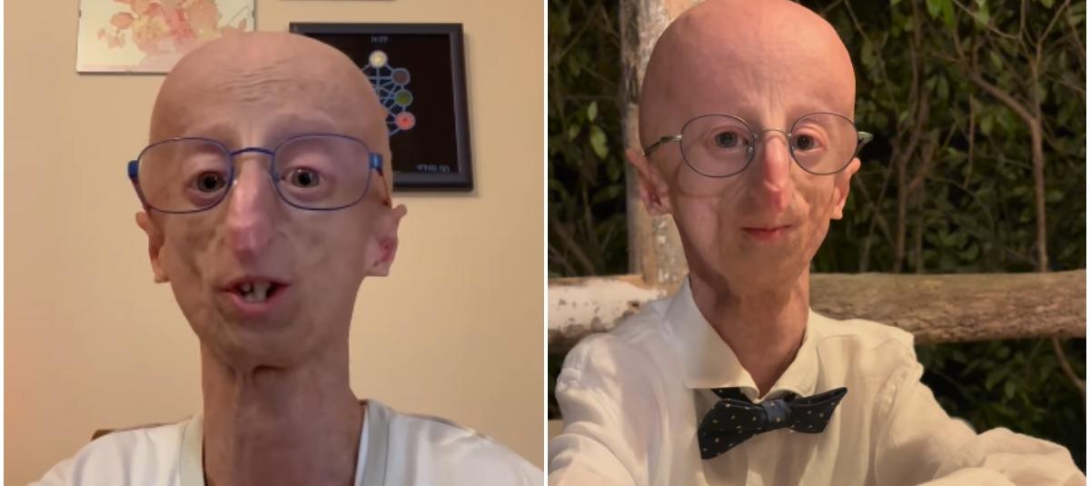 ¿Qué es la progeria, la extraña enfermedad que padecía Sammy Basso y ...