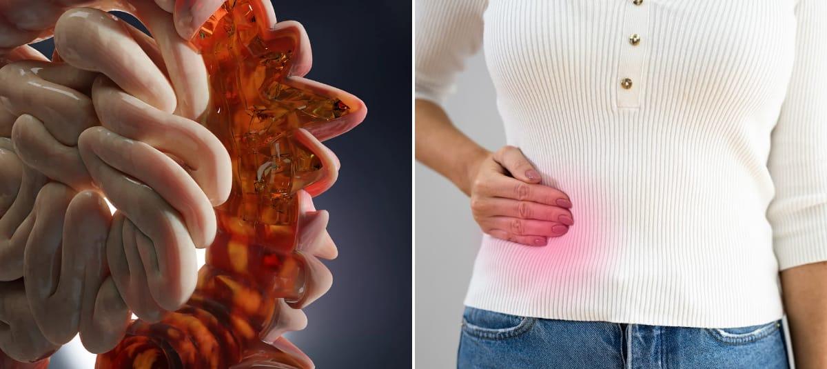 Cirujano explica los síntomas más comunes de la diverticulitis y cómo ...