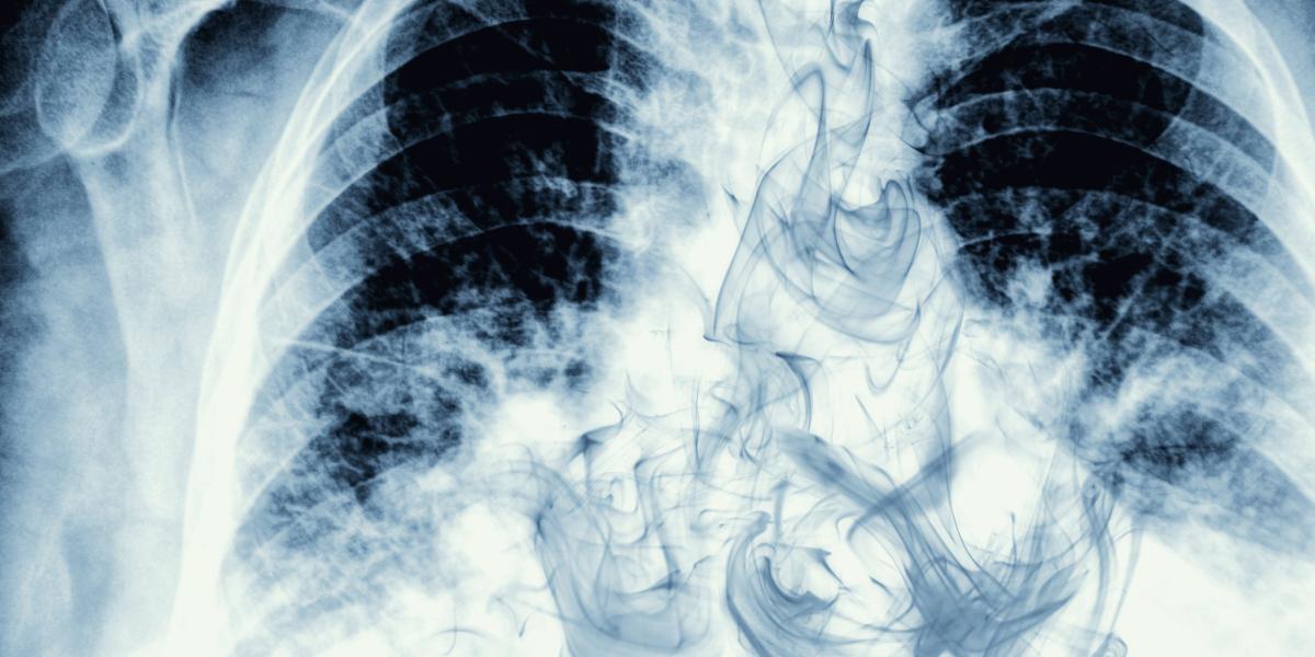 Se le perdió un piercing y descubrió que lo tenía incrustado en un pulmón