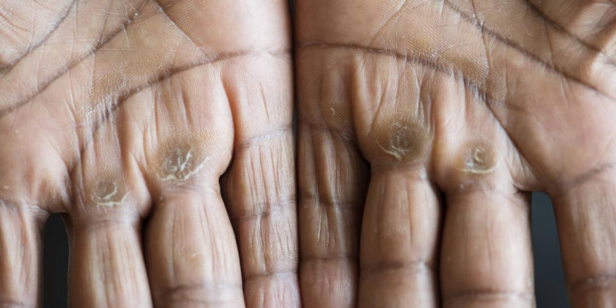 ¿Cómo eliminar los callos de las manos?