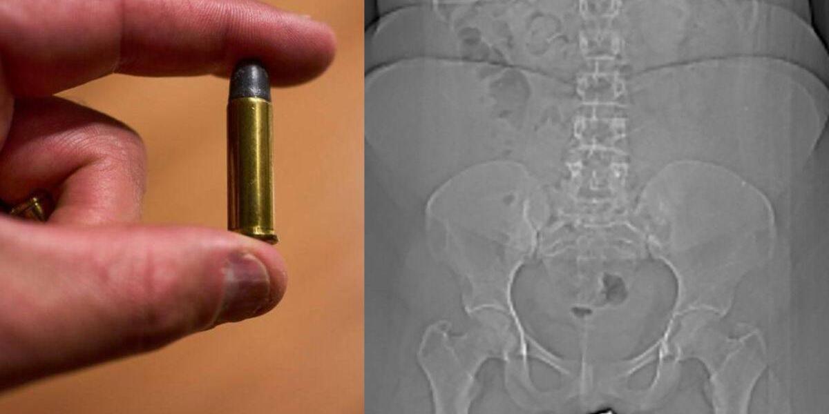 Mujer recibe disparo y bala queda ‘retenida en su clítoris’