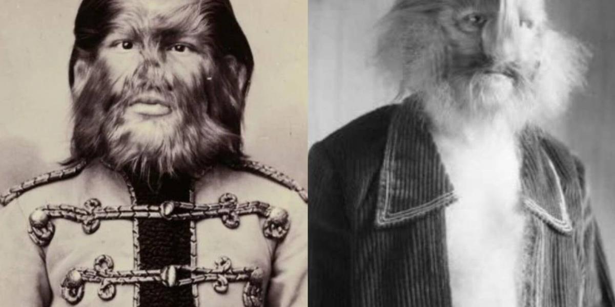 Stephan Bibrowski: el hombre con rostro de león que fue un fenómeno de ...