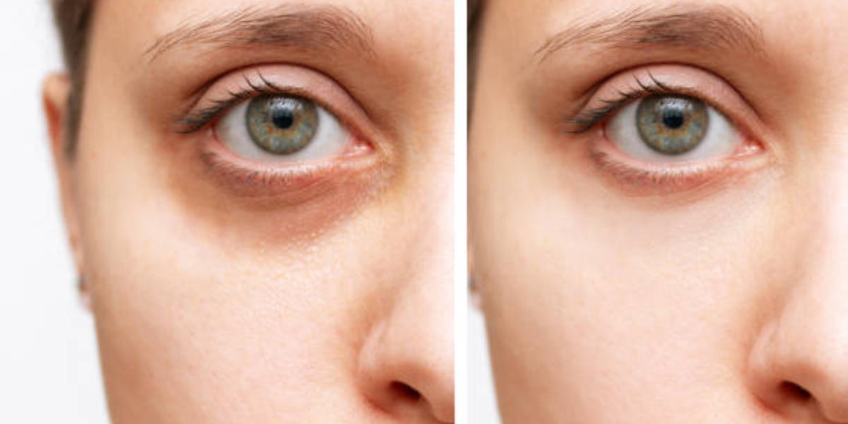 ¿Existen realmente los remedios caseros que ayudan a eliminar las ojeras?