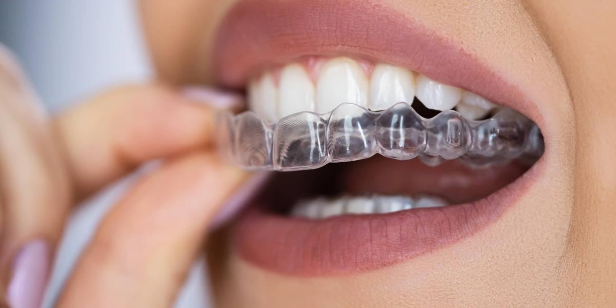 Odontología: ¿Qué son los retenedores dentales y cuál es su costo en ...
