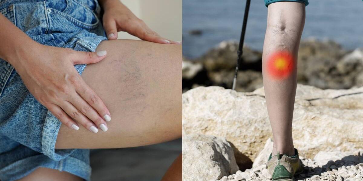 Venas várices: ¿Por qué pueden aparecer en adolescentes y qué cuidados ...