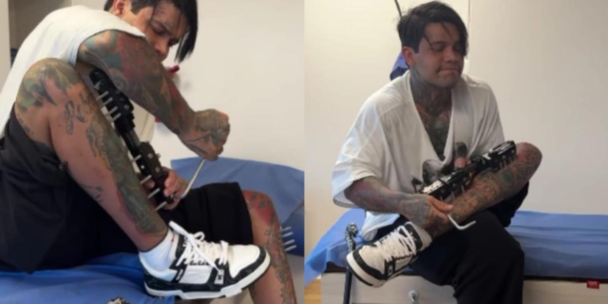 Video: Yeferson Cossio mostró cómo quedaron sus piernas tras cirugía de ...