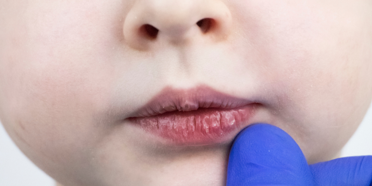 ¿Qué es el cáncer de labio? Síntomas, prevención y consejos esenciales