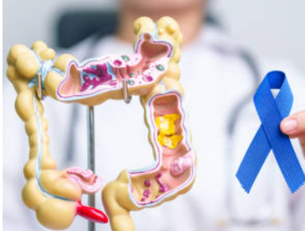 Cáncer de colon: estos son los 5 signos de alarma que debe tener en ...