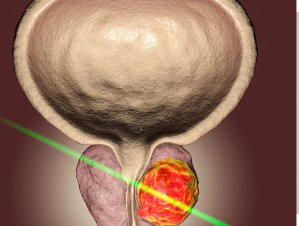 Exámenes de rutina le salvaron la vida al detectarle un cáncer de ...