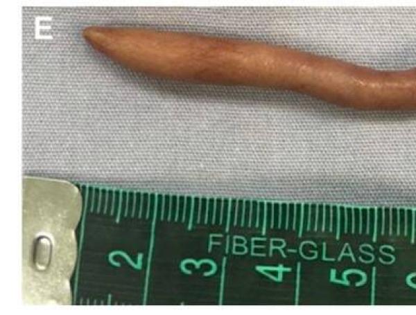 Bebé con cola de casi seis centímetros: foto del caso que impactó a médicos