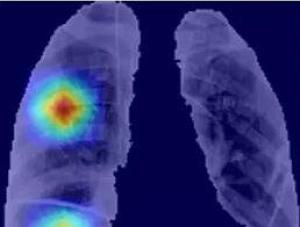 Covid-19: así se ve el alcance del daño pulmonar tras la hospitalización