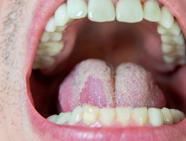 ¿De qué color debe ser la lengua? Esto dice Harvard sobre señales de ...