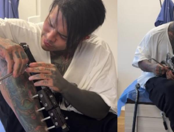 Video: Yeferson Cossio mostró cómo quedaron sus piernas tras cirugía de ...