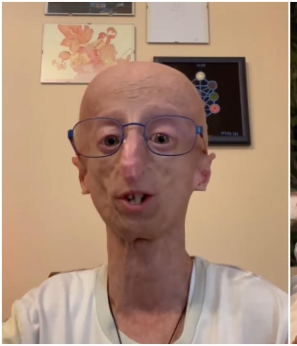 ¿Qué es la progeria, la extraña enfermedad que padecía Sammy Basso y ...