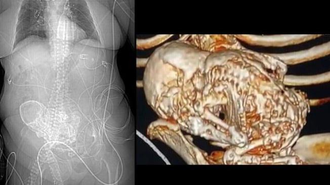 Brasil: Mujer fue al médico por una caída y le encontraron un feto ...