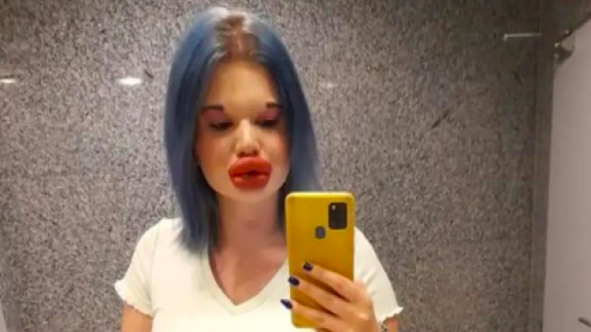 Mujer en Bulgaria se puso 30 inyecciones en los labios ser Barbie humana