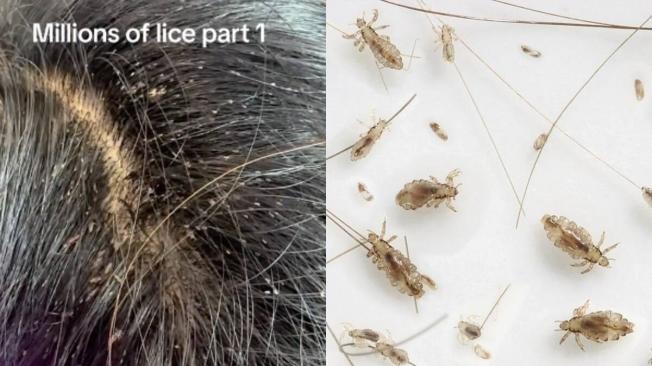 ¿Se pueden eliminar los piojos con remedios caseros? Los cuidados que ...