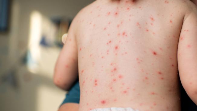 Varicela: ¿Cuánto es el tiempo que dura esta enfermedad en el cuerpo?