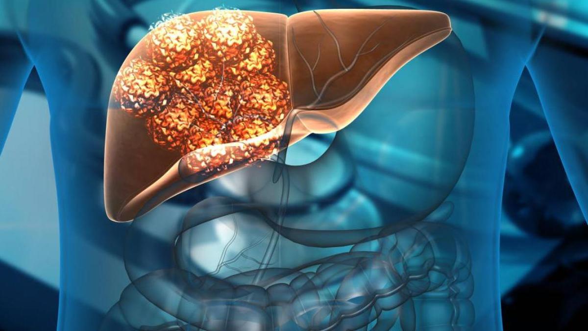 Hepatitis A alerta a Medellín: estos sus síntomas y cómo se trasmite