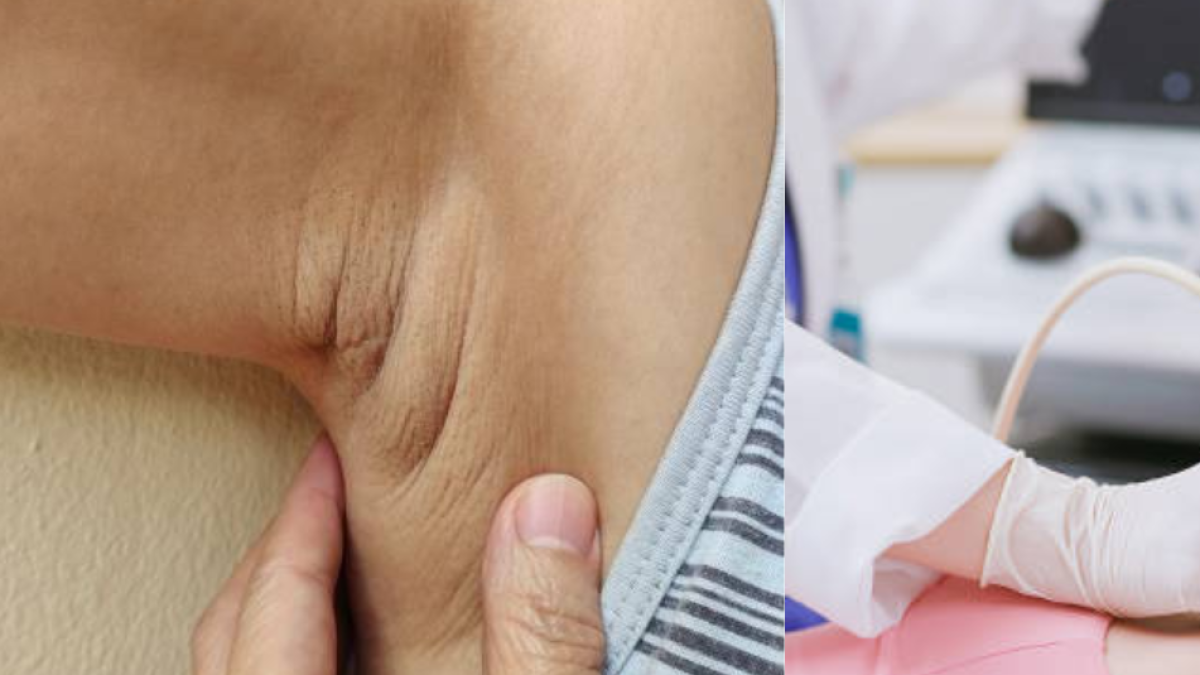 'Me salió un bulto en la axila': causas y cuándo ir al médico según los ...