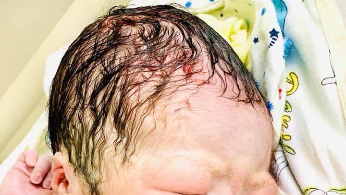 DIU: Imagen de bebé que nace agarrado al DIU de su madre en Vietnam