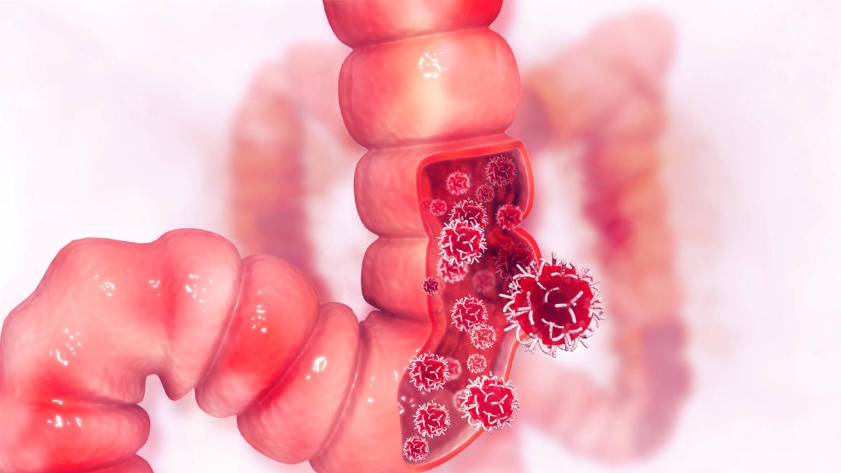 Cáncer de colon: ¿cuáles son las causas y los posibles tratamientos?