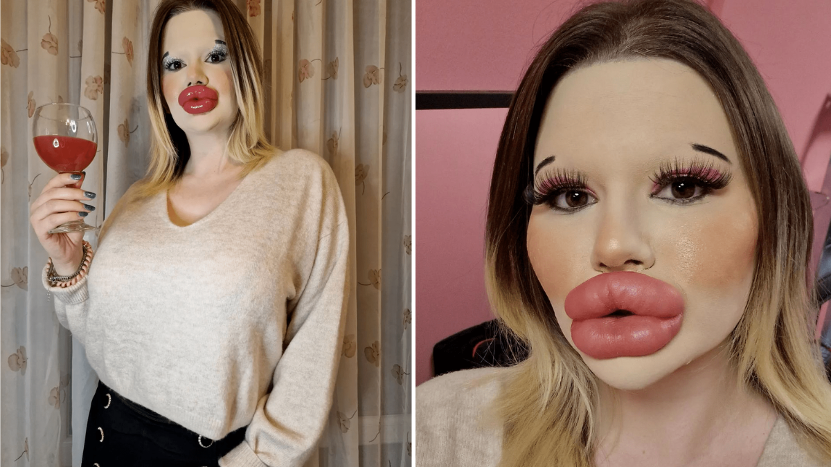 Andrea Ivanova: mujer con labios más grandes del mundo quiere más pómulos