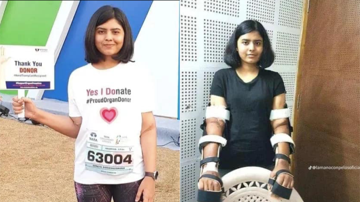 Shreya Siddanagowder: la joven que recibió trasplante de manos de un hombre