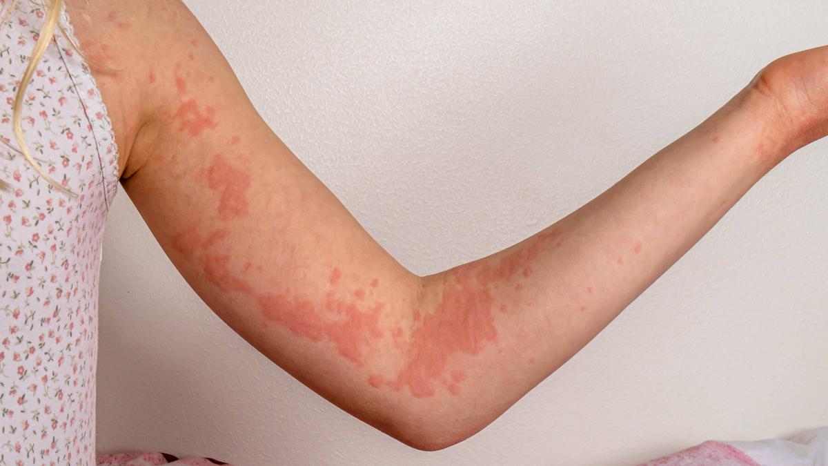 Cuidado con las ronchas en la piel: Cuatro recomendaciones para la ...