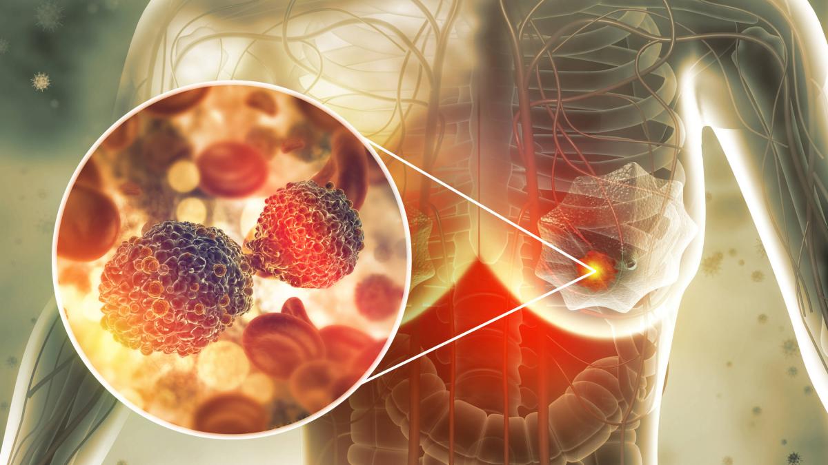 Cáncer de seno: cómo detectarlo y ocho preguntas que debe saber de la ...