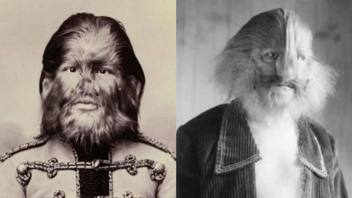 Stephan Bibrowski: el hombre con rostro de león que fue un fenómeno de ...